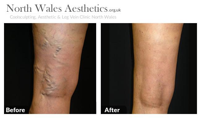 Leg Thread, Varicose And Reticular Vein Treatments :: North Wales ...
